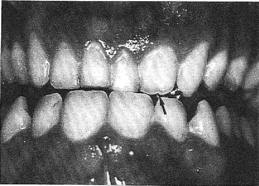 Dens invaginatus in a mandibular lateral incisor